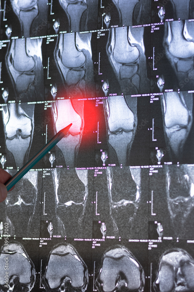 Doctor examining bone knee tumor. X-ray and MRI, MRT, CT with marked ...