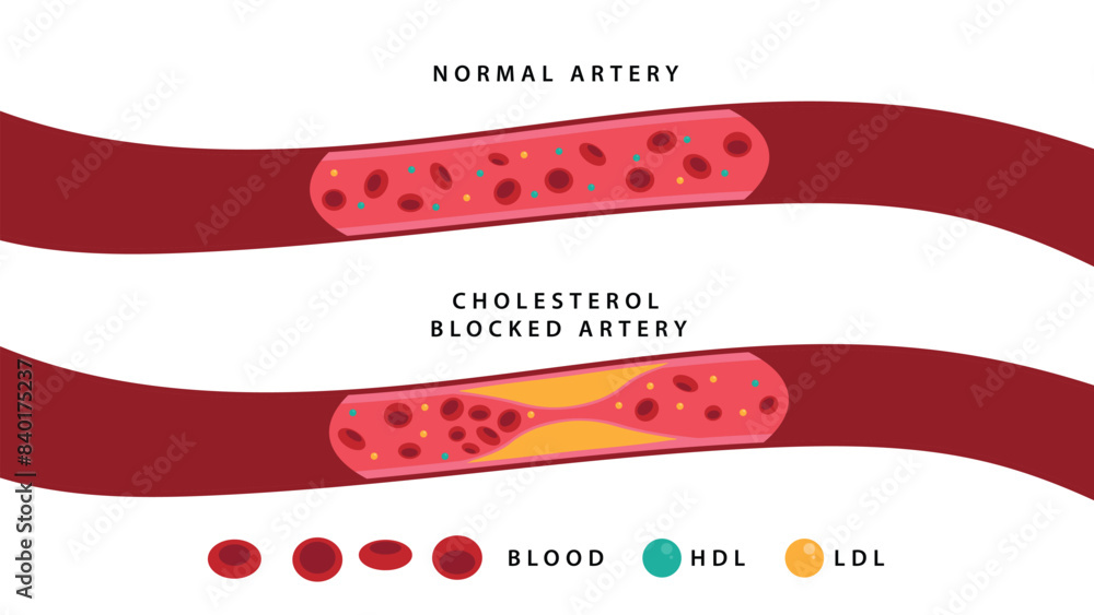 Types of cholesterol blood flow. Normal, Blocked artery. High-Density ...