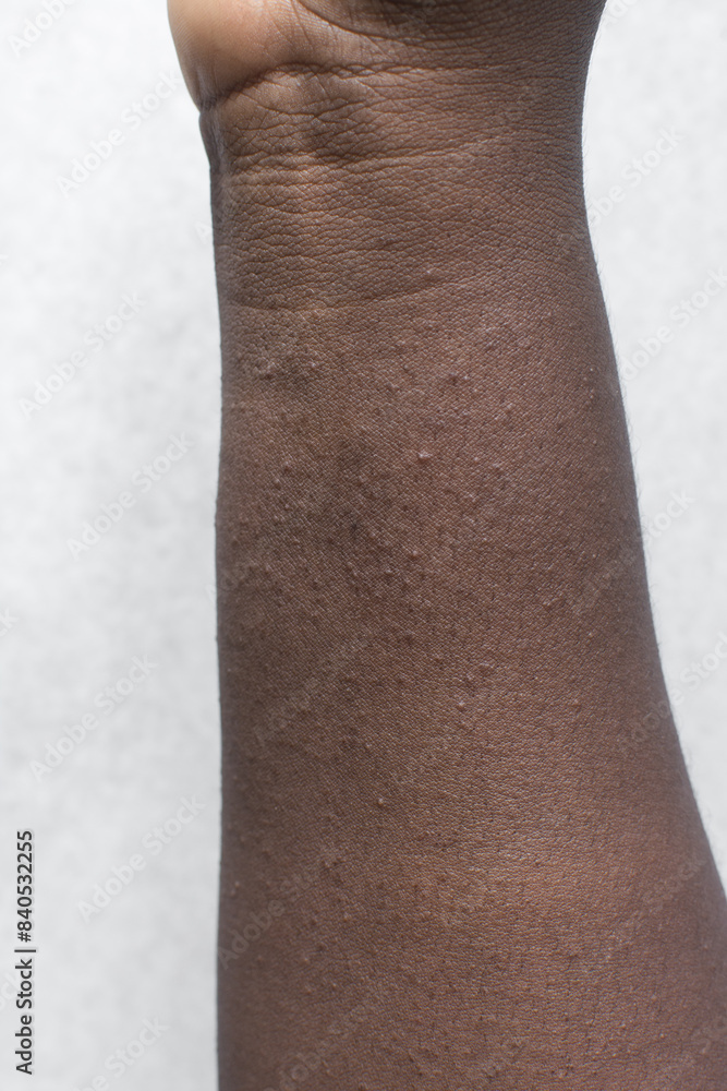 overhead view of Heat rash on brown skin, prickly heat rash on dark ...