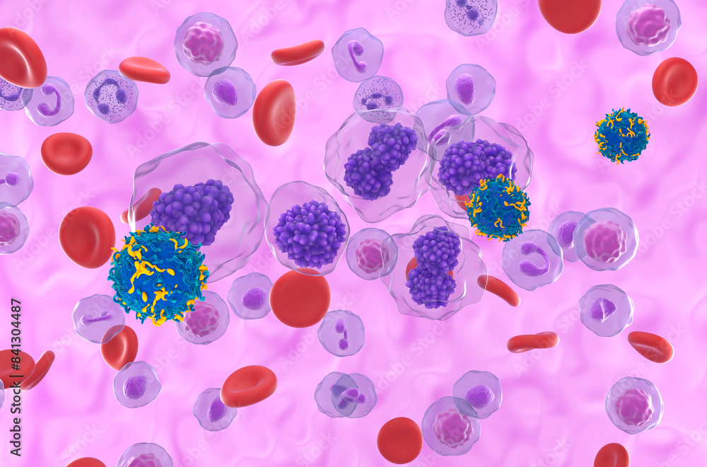 CAR T cell therapy in Plasma cell leukemia (PCL) - isometric view 3d ...