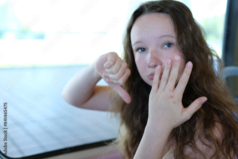 A young girl sadly shows her hand with warts. Many viral warts on the ...
