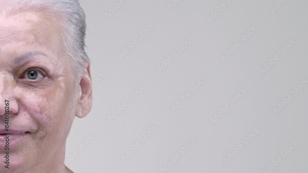Portrait: gray-haired old woman with vitiligo on her face poses, shows ...