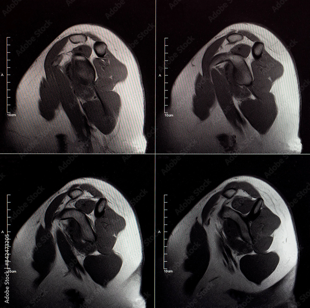 MRI image of the shoulder joint after a fracture and dislocation ...