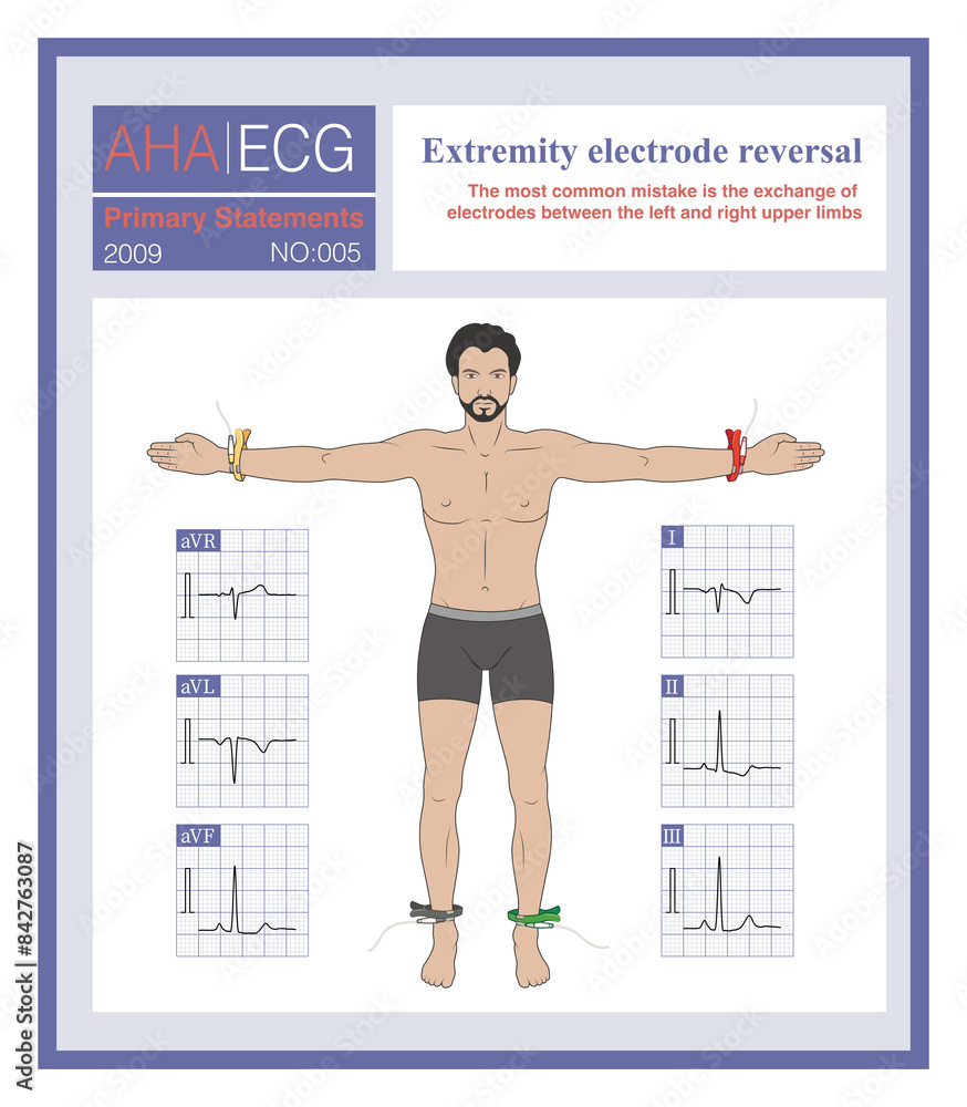 When the limb leads are reversed, it is common for the left upper limb ...