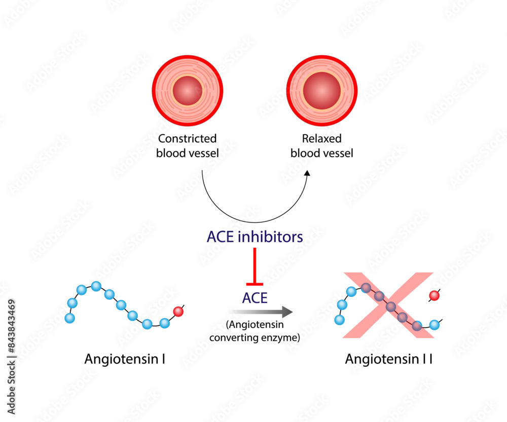 Angiotensin-converting enzyme inhibitors, ACE inhibitors. Renin-Angiotensin-Aldosterone System ...