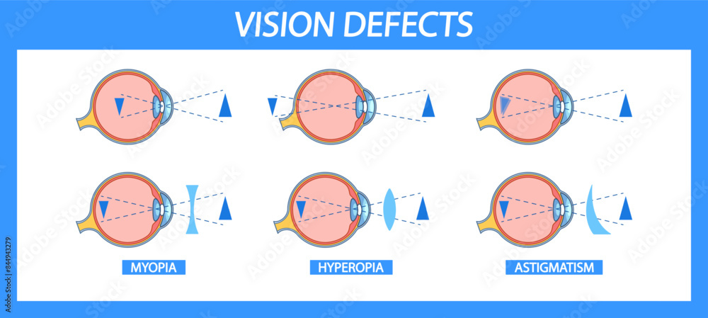 Informative Chart Detailing Myopia, Hyperopia, And Astigmatism In Eye ...