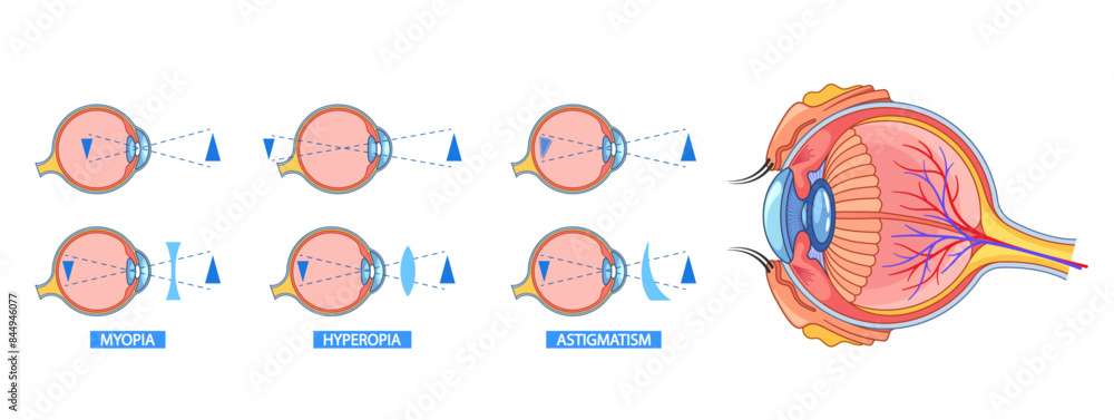 Detailed Eye Anatomy Infographic Explaining Myopia, Hyperopia, And ...