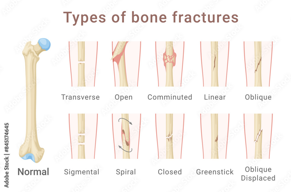 Types of femoral shaft bone fracture medical scheme infographic ...