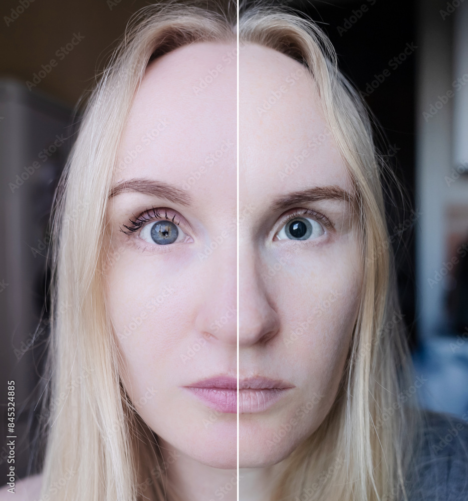 Foto de Before and after eye drops to examine the fundus, pupil ...