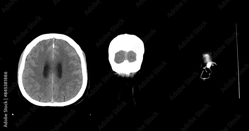 A CT scan of the brain shows a subarachnoid hemorrhage scattered at ...