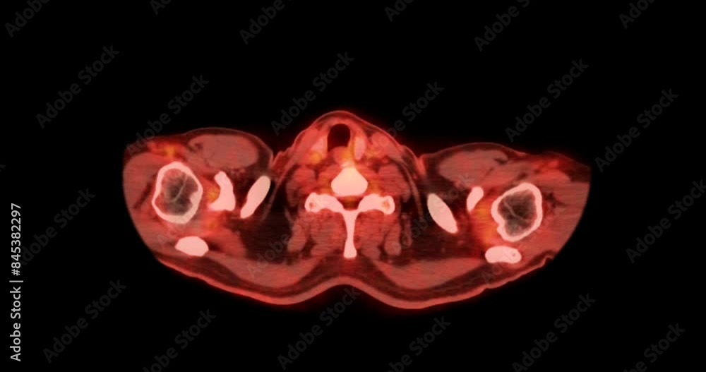 A PET CT scan reveals cholangiocarcinoma with suspected metastatic involvement of the lungs and ...
