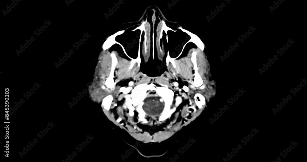 A CT scan of the brain shows a subarachnoid hemorrhage scattered at ...