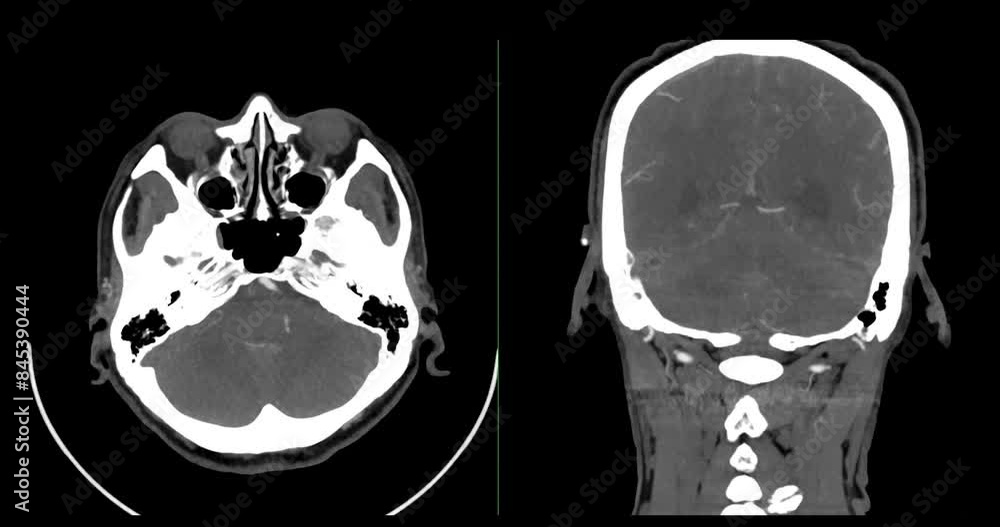 A CT scan of the brain shows a subarachnoid hemorrhage scattered at ...