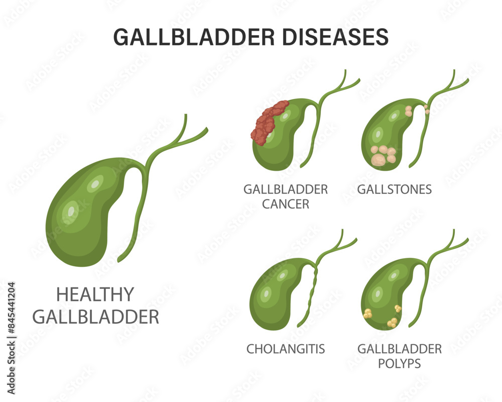 Gallbladder diseases infographics. Gallstone disease, cancer, acute ...