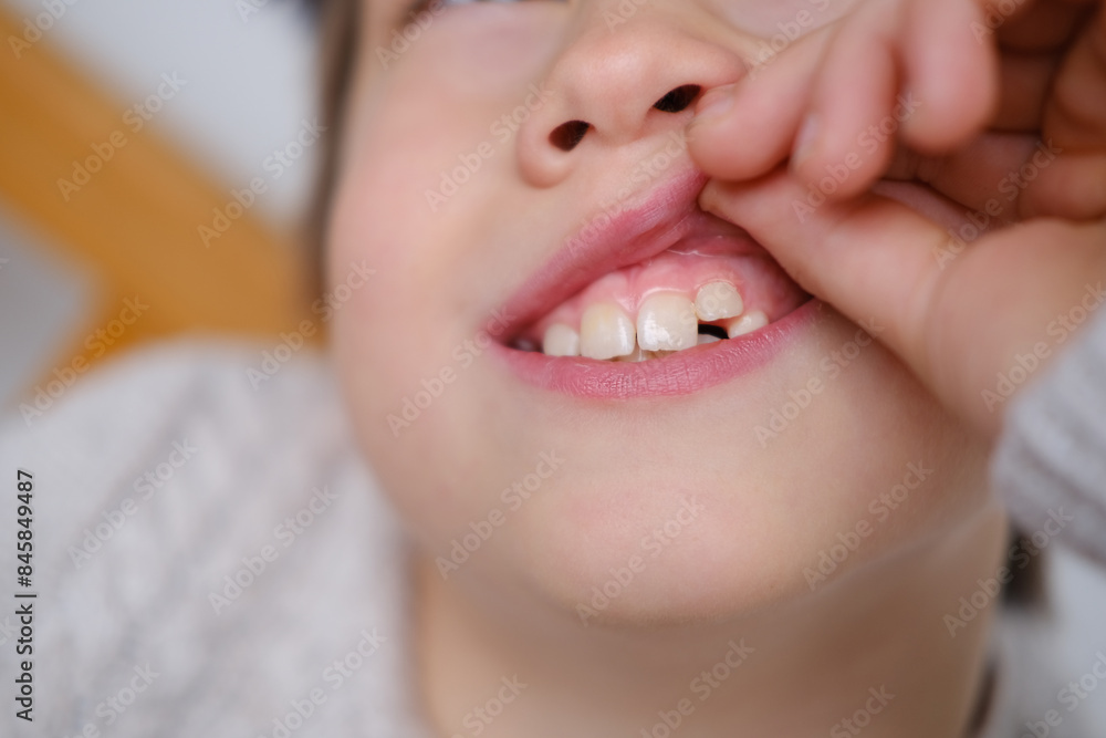 Young Smiling child, boy, age 10 reveals growing teeth, marking ...