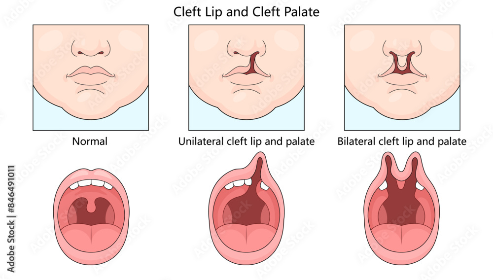 Vetor De Normal Unilateral Cleft Lip And Palate And Bilateral Cleft