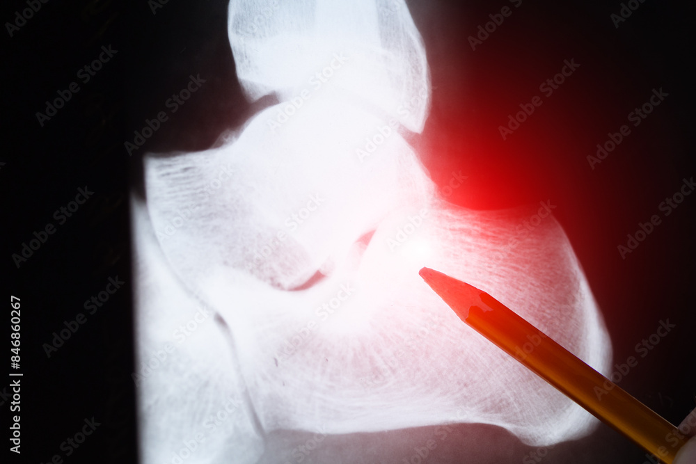 Doctor examining X-ray scan of Calcaneus or heel bone destruction. Bone ...