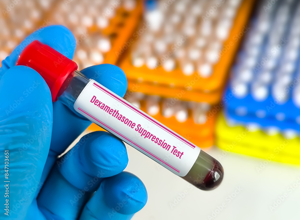 Dexamethasone Suppression Test measures the response of the adrenal ...