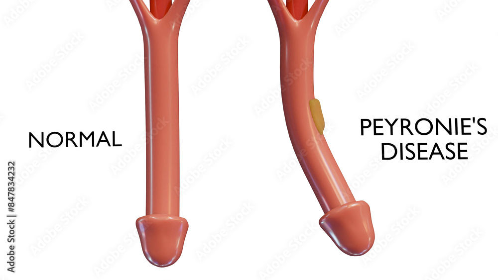 3d Rendering Of Peyronies Disease Is A Connective Tissue Disorder That Causes Abnormal Lumps