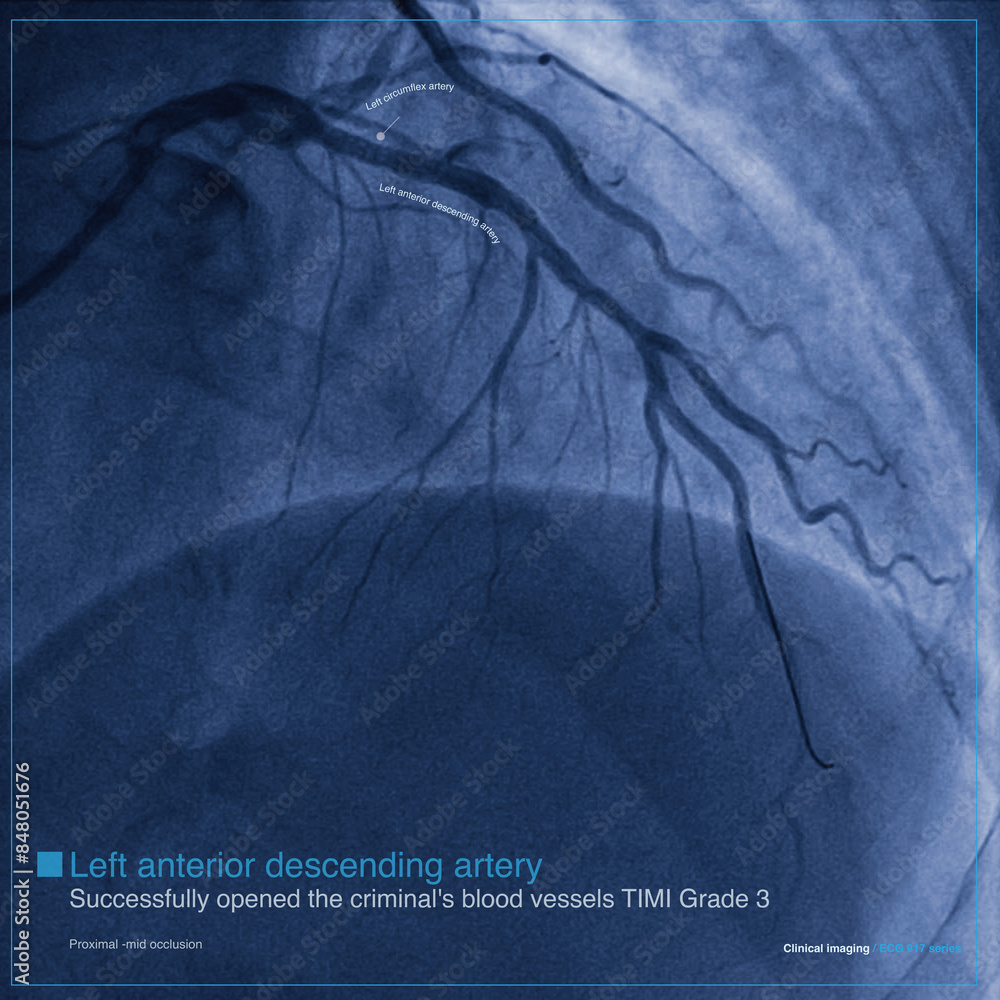 A 65-year-old man was admitted to the hospital with chest pain for 2 ...