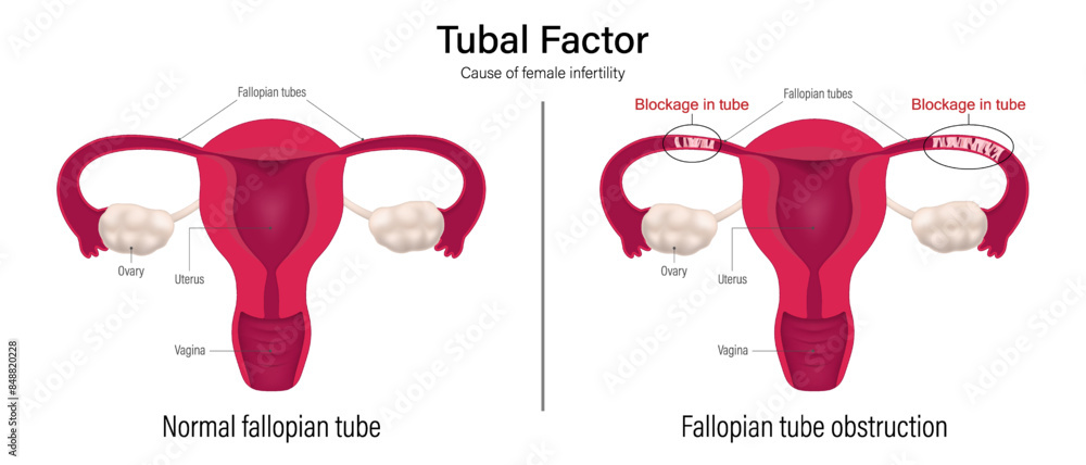 Female infertility vector. Comparison of normal fallopian tube and ... Female infertility vector. Comparison of normal fallopian tube and ...