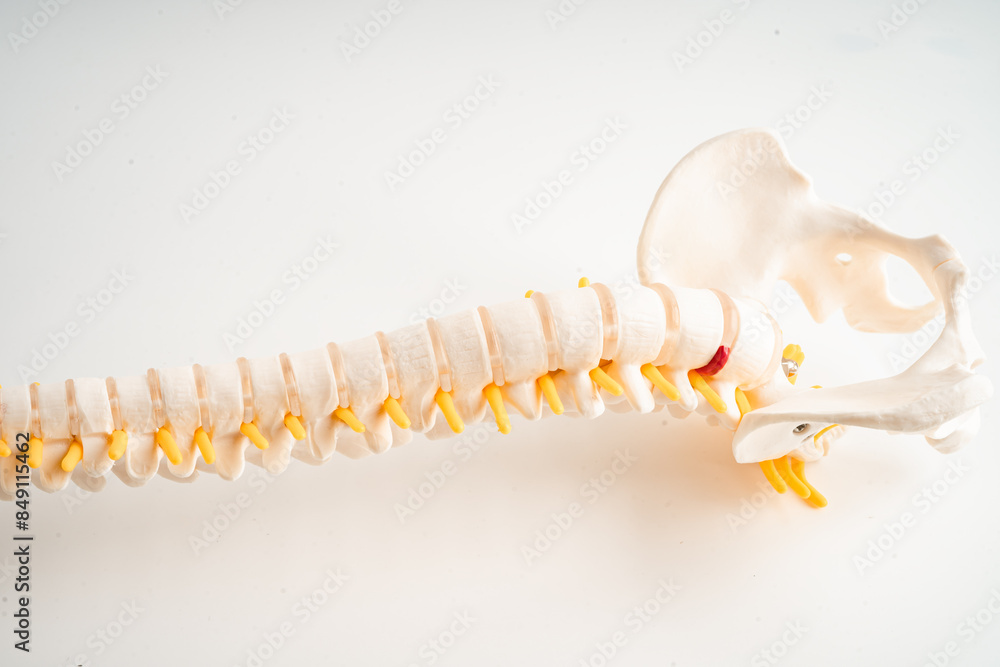 Lumbar spine displaced herniated disc fragment, spinal nerve and bone ...