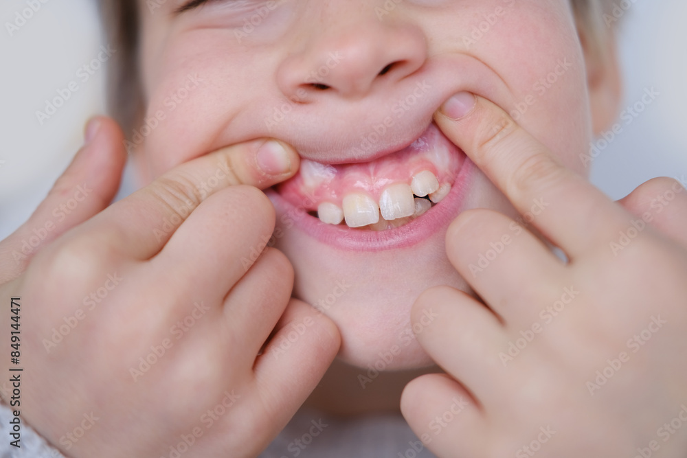 Young Smiling child, boy, age 10 reveals growing teeth, marking ...