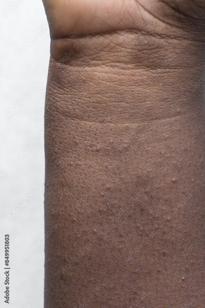 Heat rash on brown skin, prickly heat rash on dark skin, Miliaria on ...