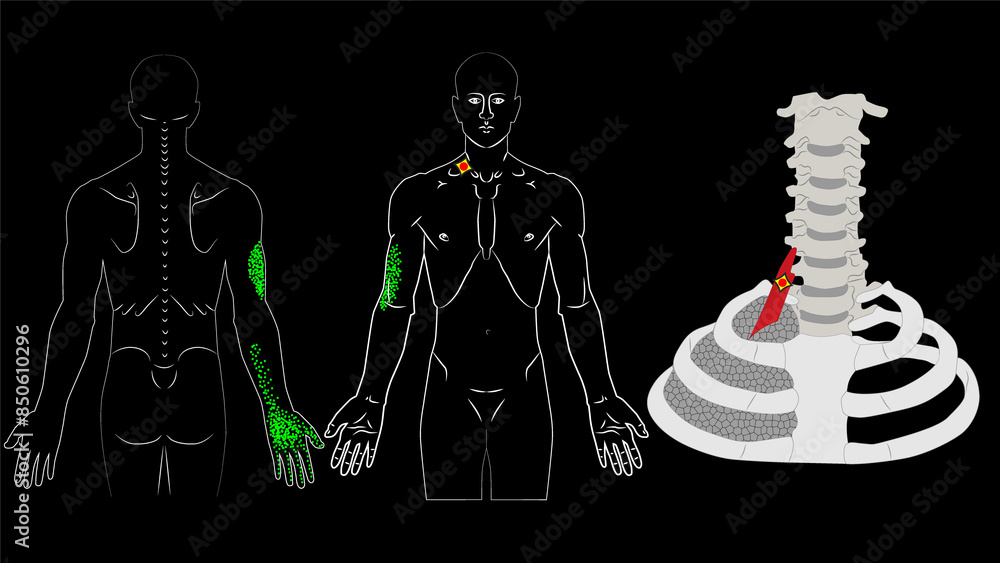 Scalene muscles illustration. Muscles, Trigger Points and Referred Trigger Pain Stock ...