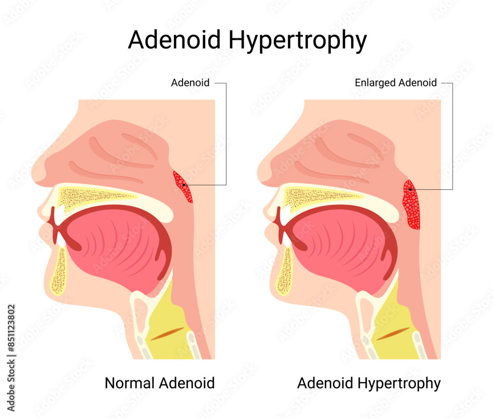 Normal adenoids and adenoid hypertrophy Stock Vector | Adobe Stock