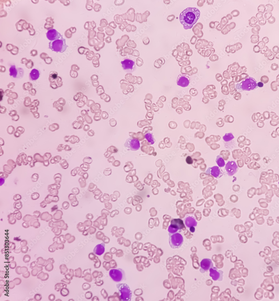 BMS(Bone marrow Study), Acute leukemia, Acute lymphoblastic leukemia ...