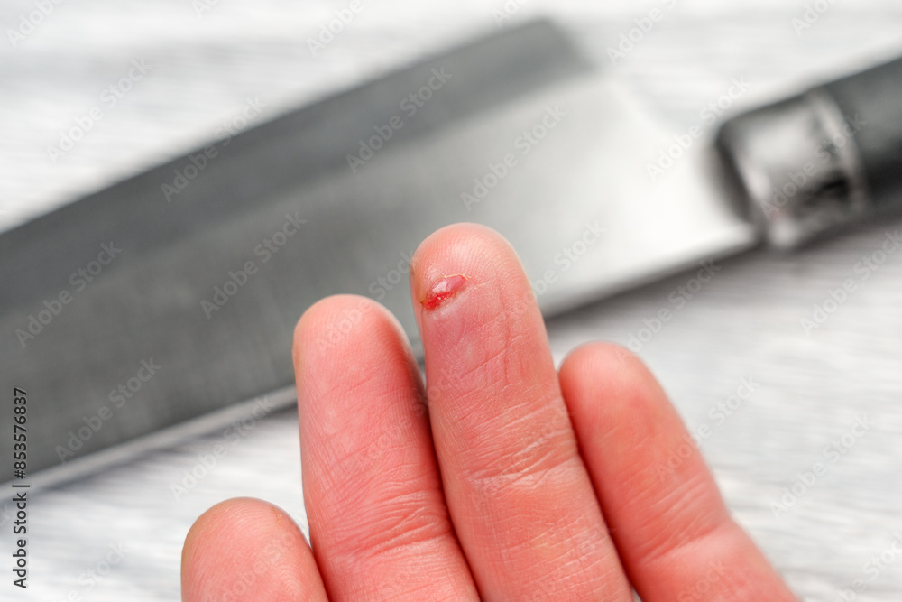 Finger wound with a skin cut and a knife Stock Photo | Adobe Stock