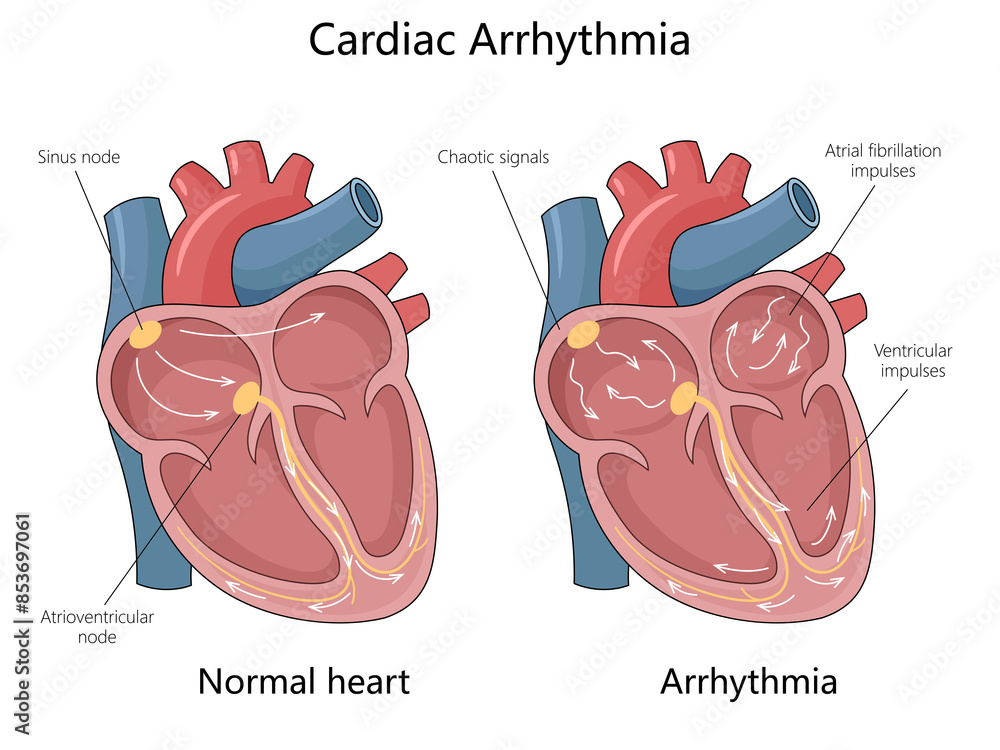normal heart with cardiac arrhythmia, showing sinus node, chaotic signals, and atrial ...