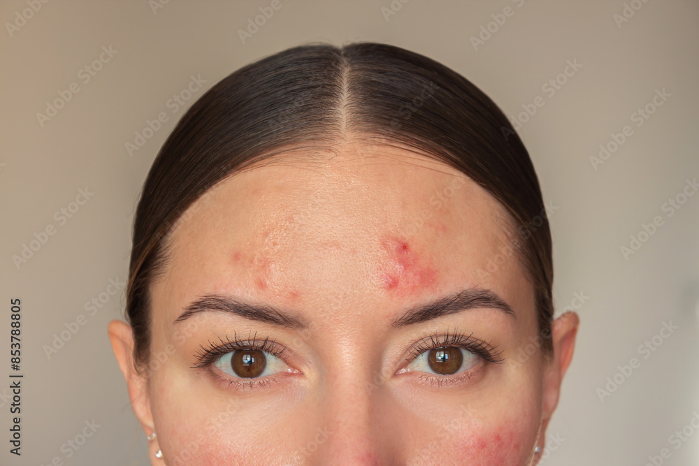 Close-up photo of young Caucasian woman with pimples on her forehead in ...