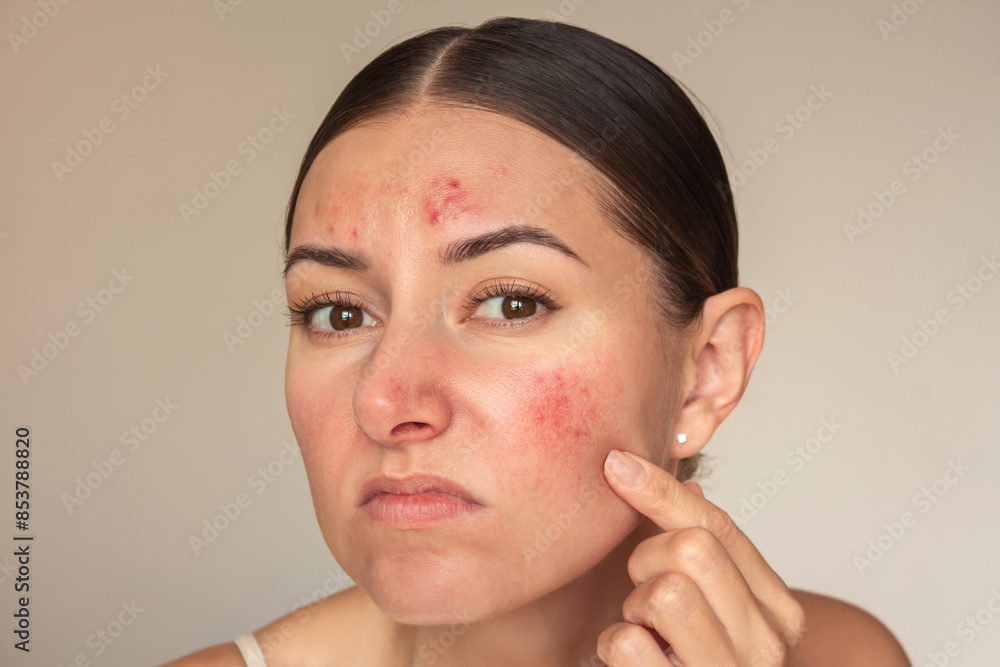 Young brunette Caucasian woman examines the pimples on her face. Girl ...