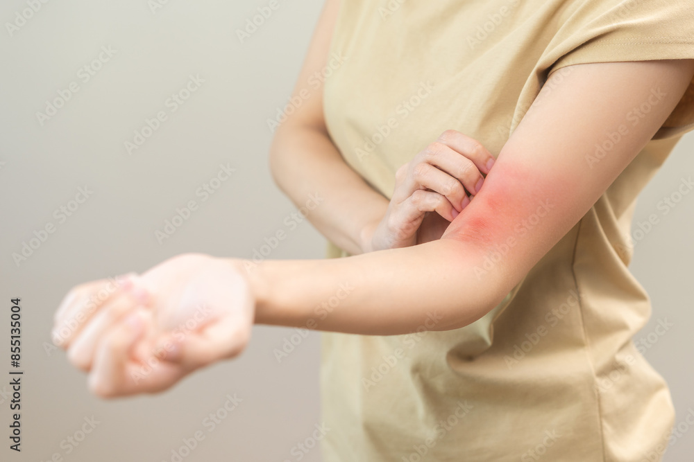 Póster Dermatology asian young woman, girl allergy, allergic reaction ...