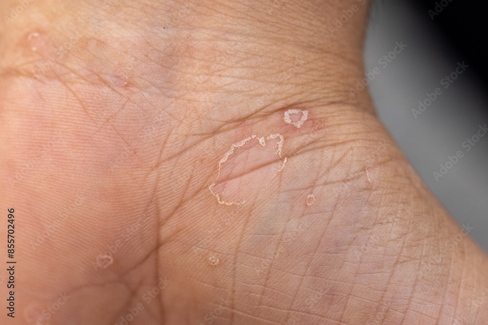 Background image of wounds caused by Systemic Lupus erythematosus (SLE ...