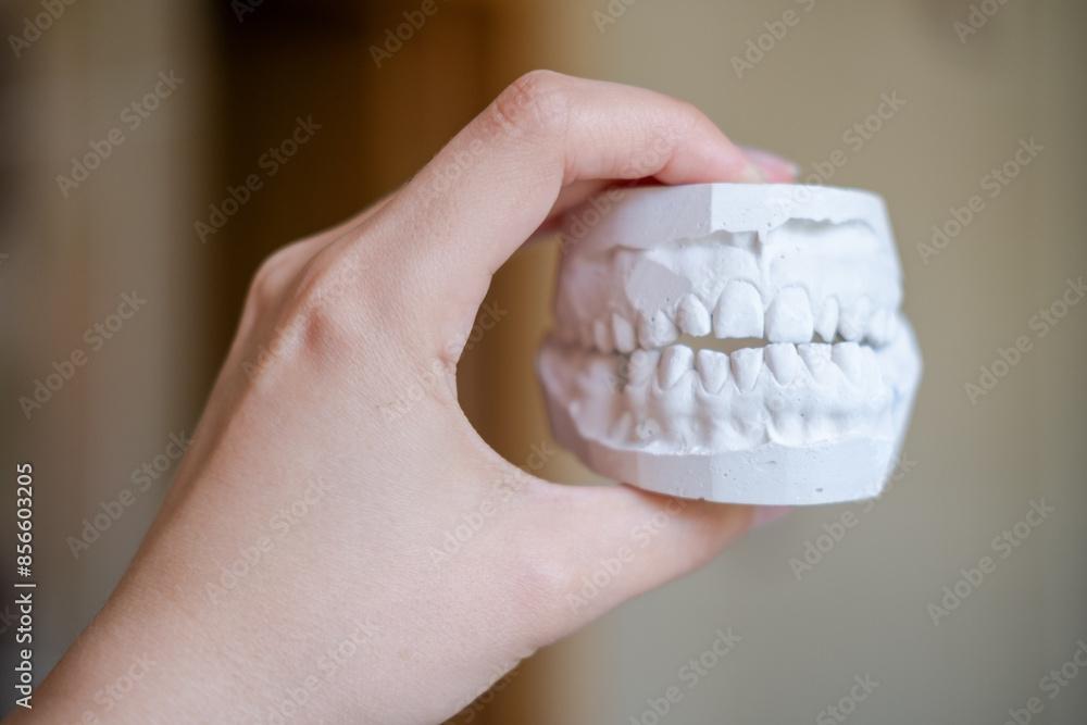 White plaster impression of the dental jaw of a patient with crooked ...