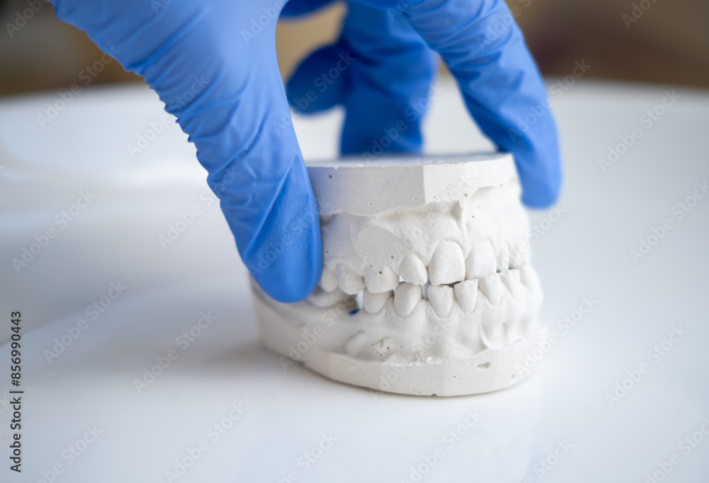 White plaster impression of the dental jaw of a patient with crooked ...