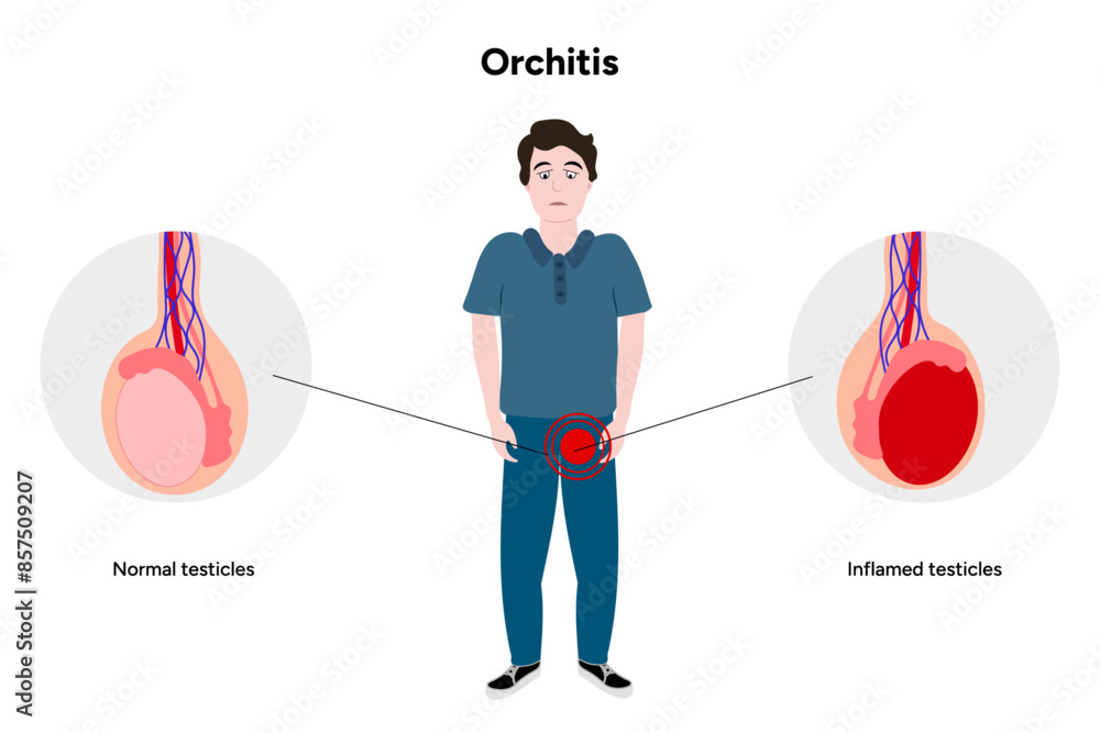 Man with Male Orchitis Testis disease Inflamed and normal testicles ...