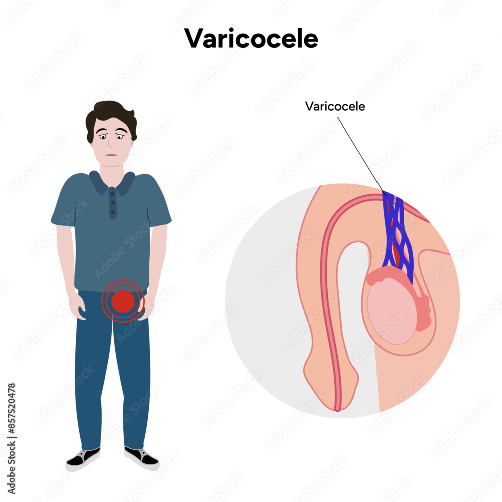 Varicocele male disease Stock Vector | Adobe Stock