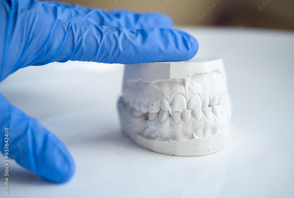 Foto de White plaster impression of the dental jaw of a patient with ...