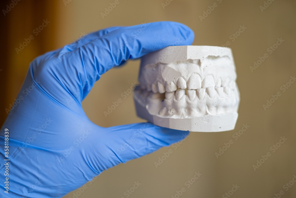 White plaster impression of the dental jaw of a patient with crooked ...