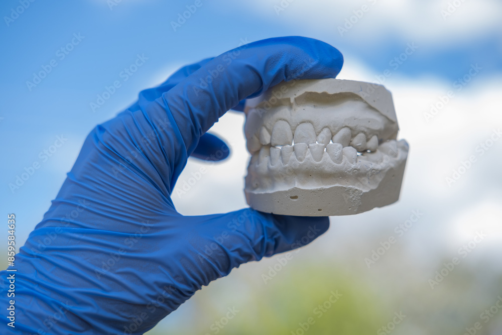 White plaster impression of the dental jaw of a patient with crooked ...