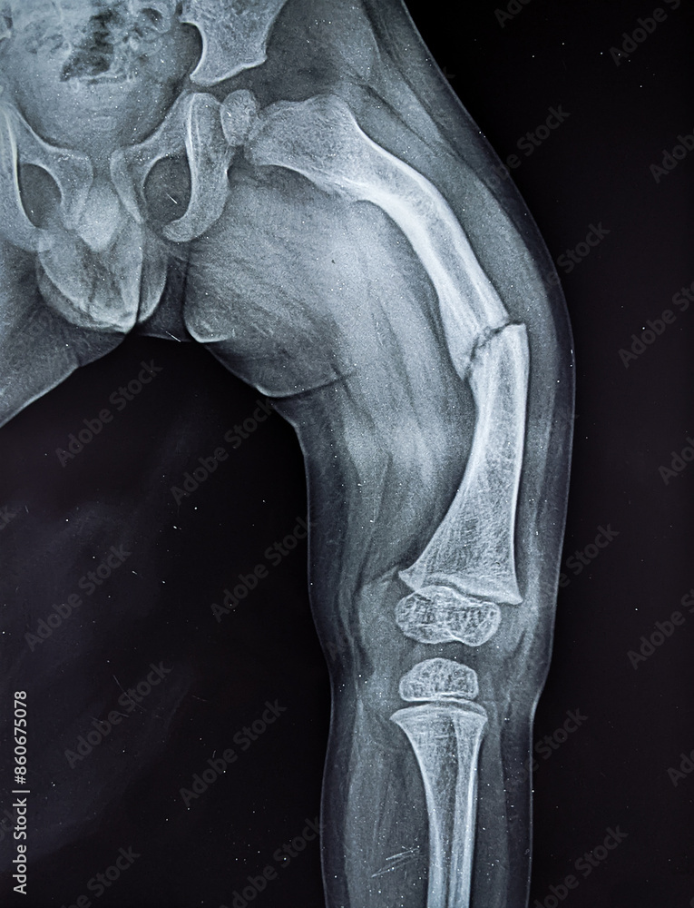 X ray of thigh showing femur fracture and metaphyseal flaring , bowed ...