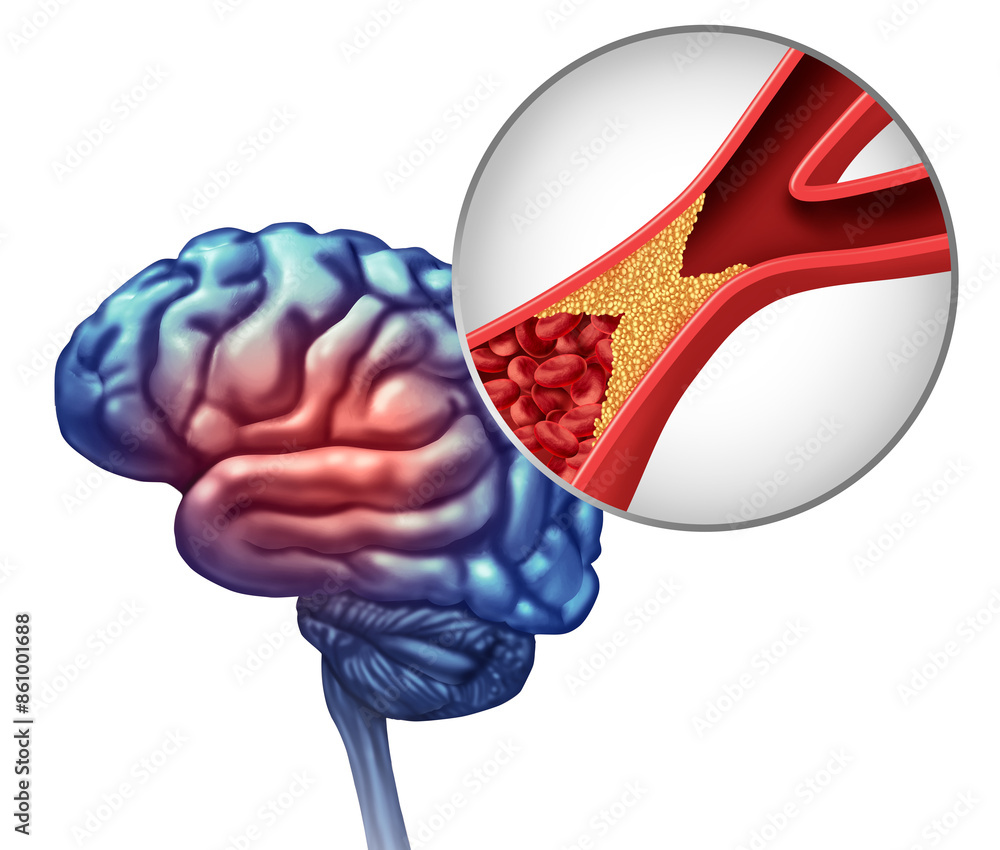 Brain stroke attack as blood flow in the brain fully blocked in an ...