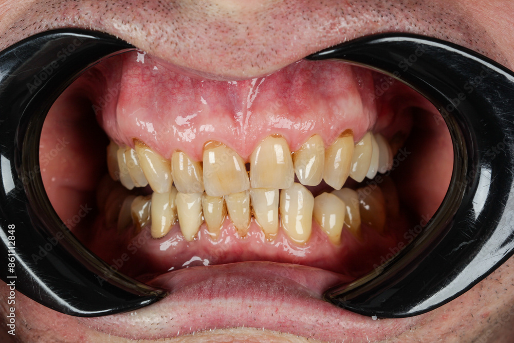 Wedge-shaped (cone-shaped) section of enamel loss in the area of the ...