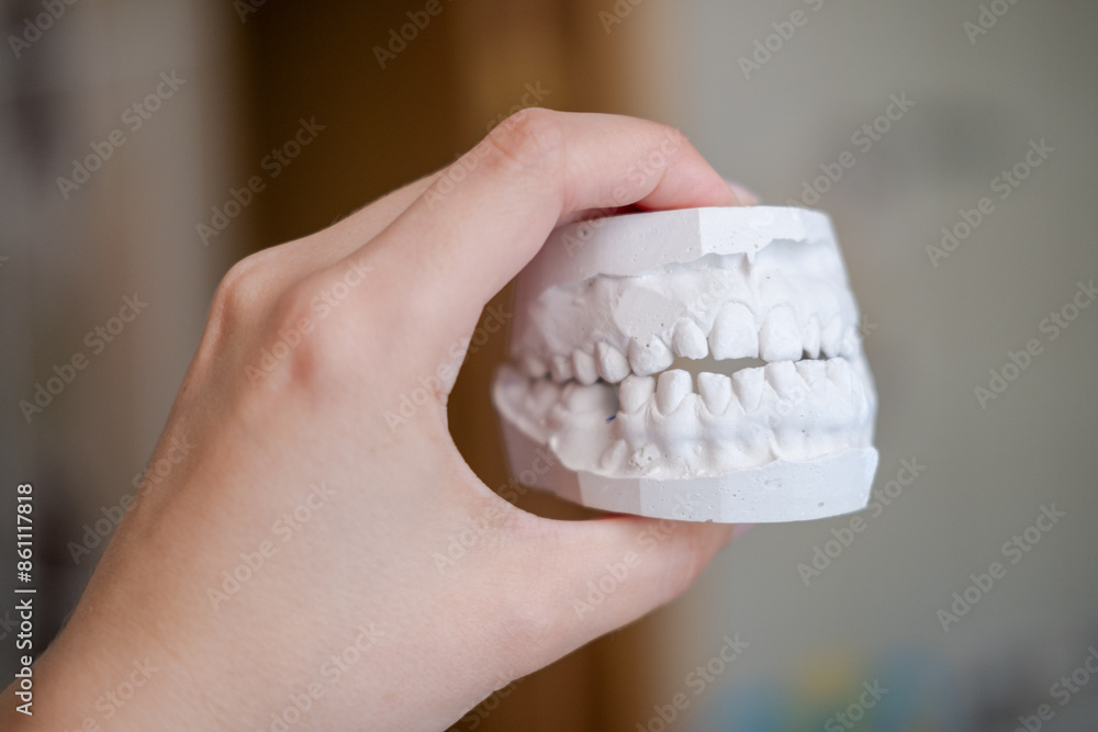 White plaster impression of the dental jaw of a patient with crooked ...