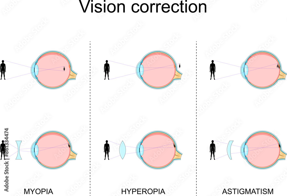 Poster Vision defects. Myopia, Hyperopia, Astigmatism. Vision ...