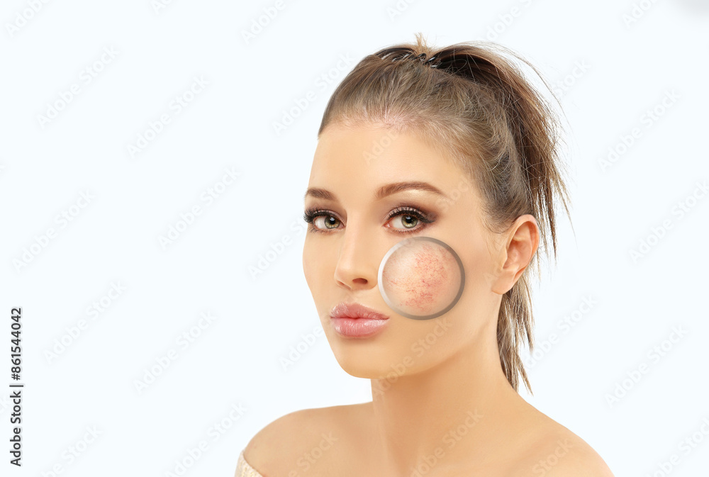 Broken blood vessels on the face,broken capillaries are tiny blood ...